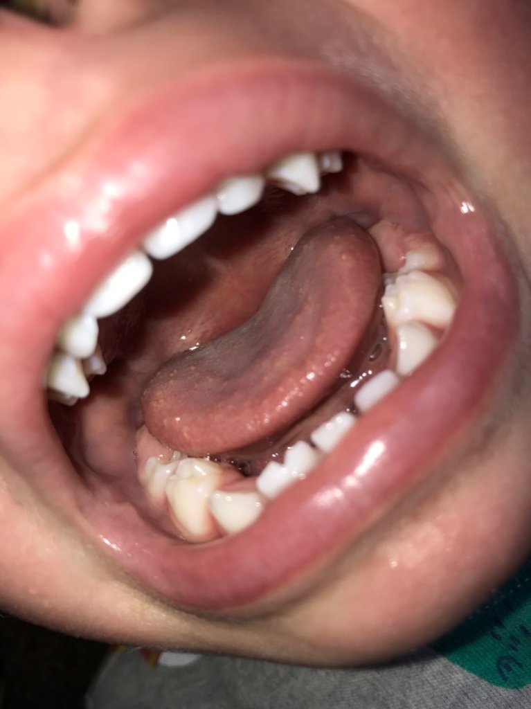 Spots In Toddlers Tongue